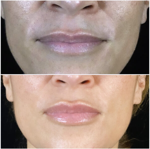 Before & After - Dr Monica Scheel Dermatology, Kailua-Kona, HI