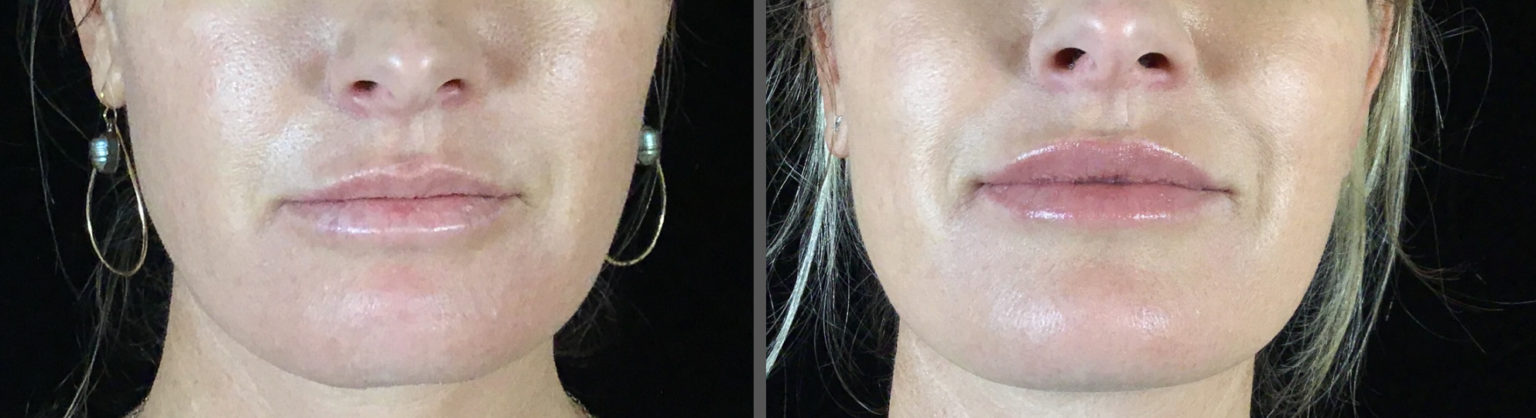 Introducing Restylane Kysse! | Dr Monica Scheel Dermatology, Kailua-Kona, HI