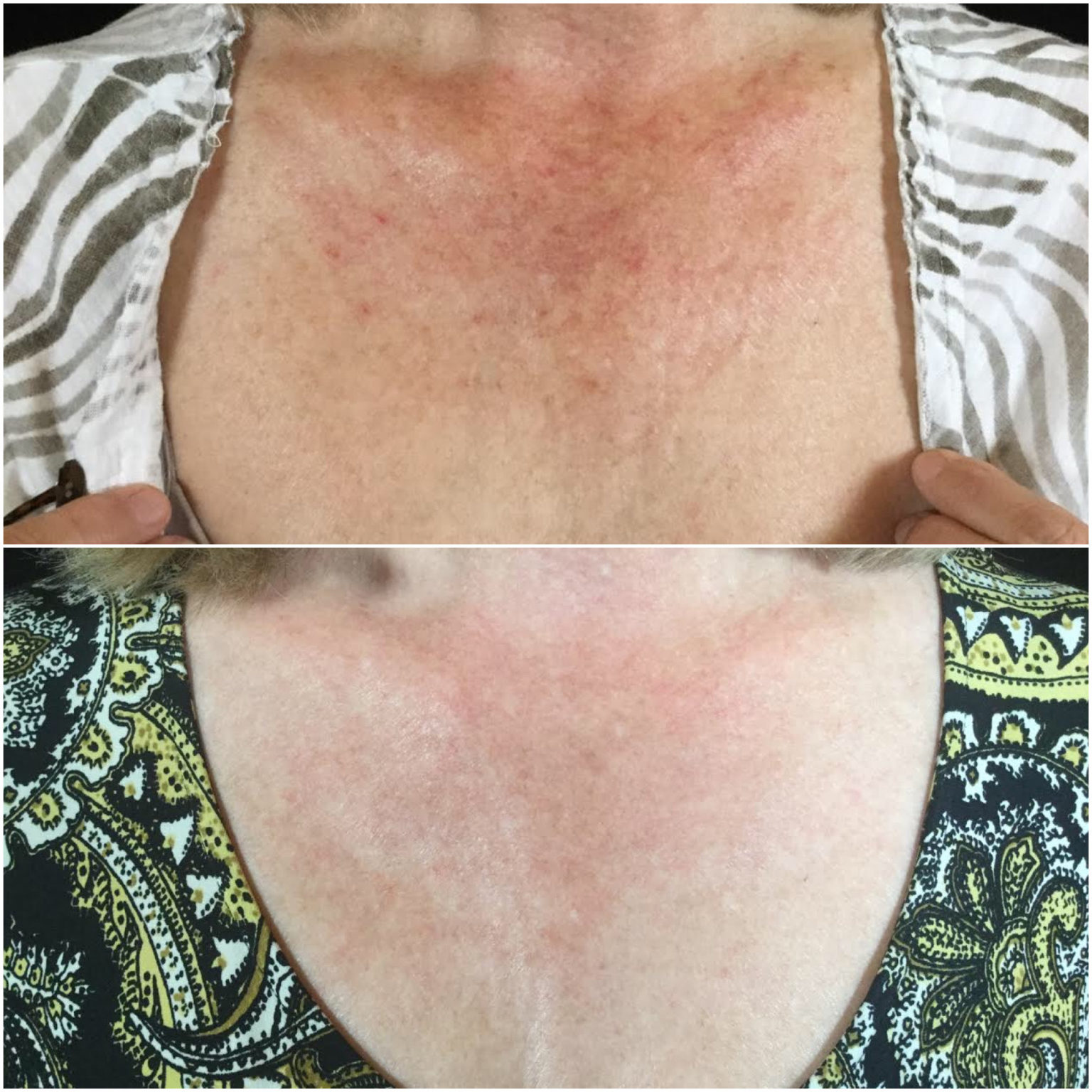 Ipl Chest - Dr Monica Scheel Dermatology