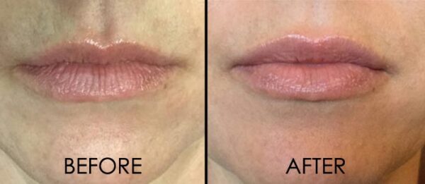 Juvederm Lips Before After - Dr Monica Scheel Dermatology