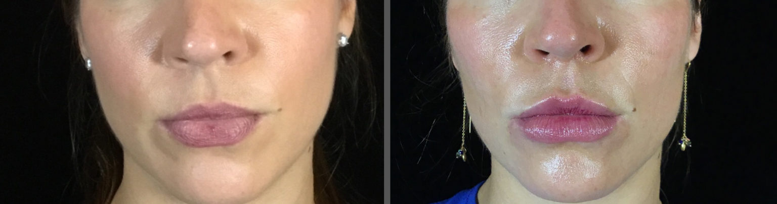 Introducing Restylane Kysse! | Dr Monica Scheel Dermatology, Kailua-Kona, HI