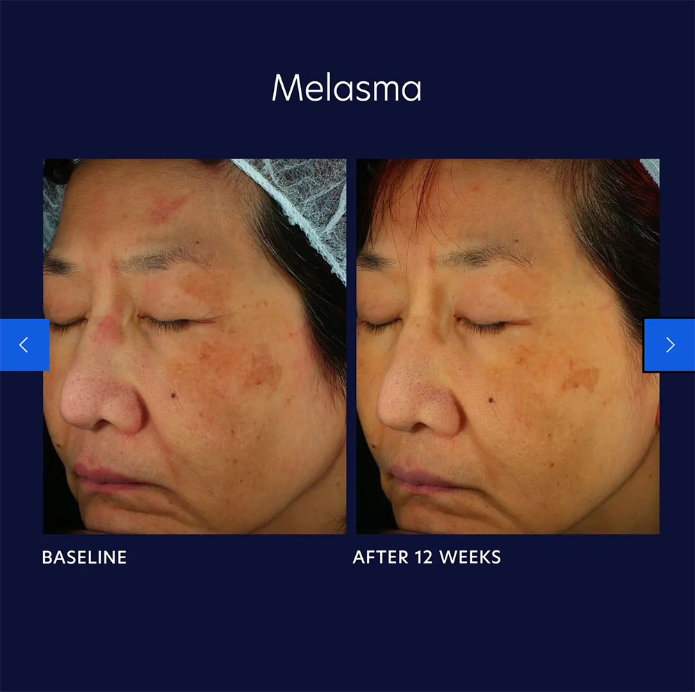 New Pigment Correct Peel | Dr Monica Scheel Dermatology, Kailua-Kona, HI
