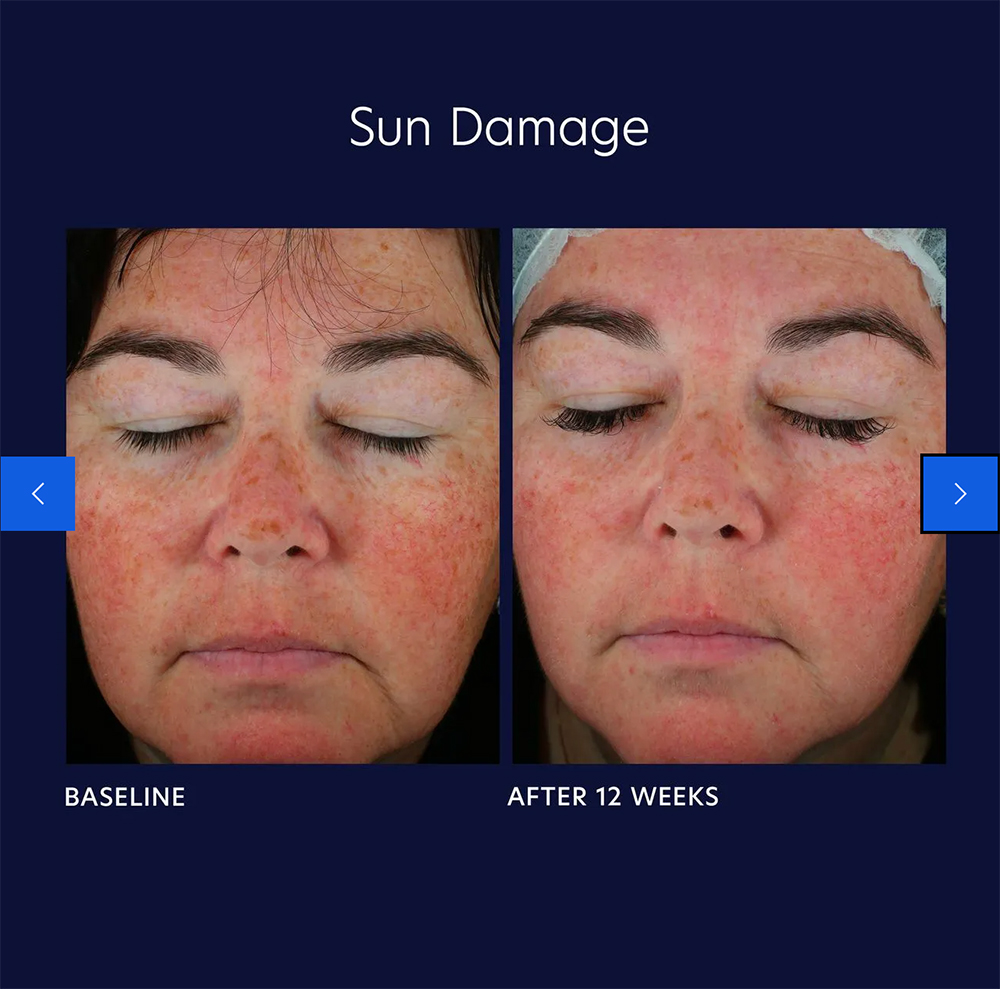 New Pigment Correct Peel | Dr Monica Scheel Dermatology, Kailua-Kona, HI