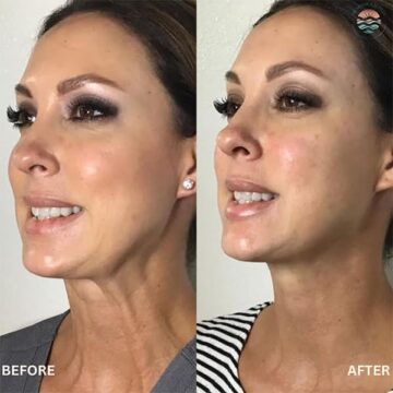 Seize the Sweet Deal Gala Special: Sweet Box of Botox | Dr Monica ...